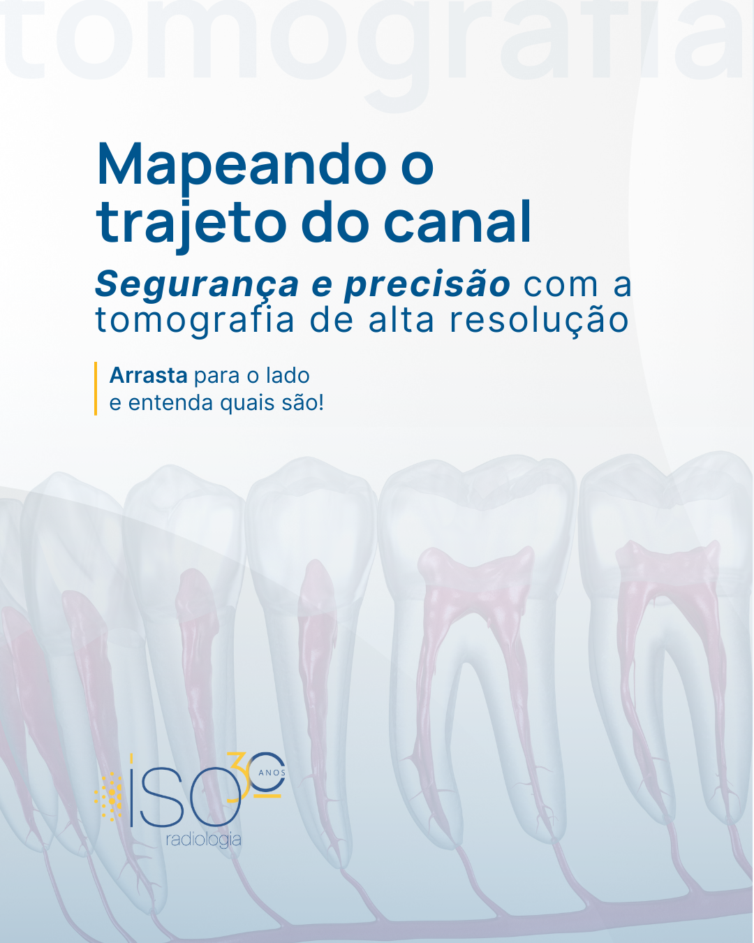Mapeando o Trajeto do Canal – ISO Radiologia